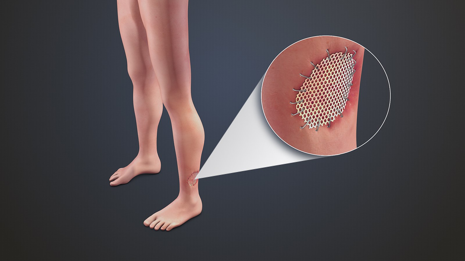 Skin Grafts Surgery 101